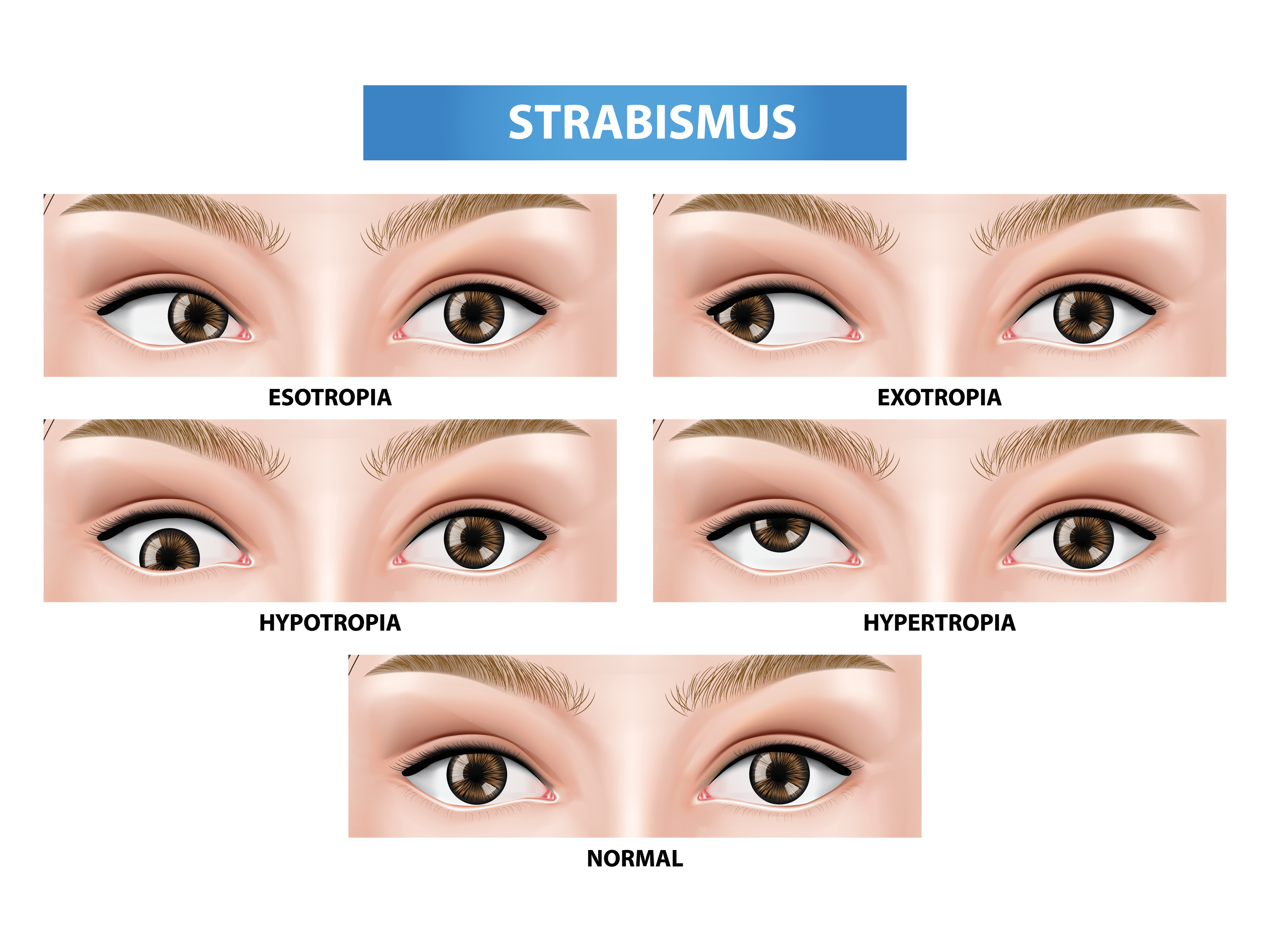 Hypertropia Eye