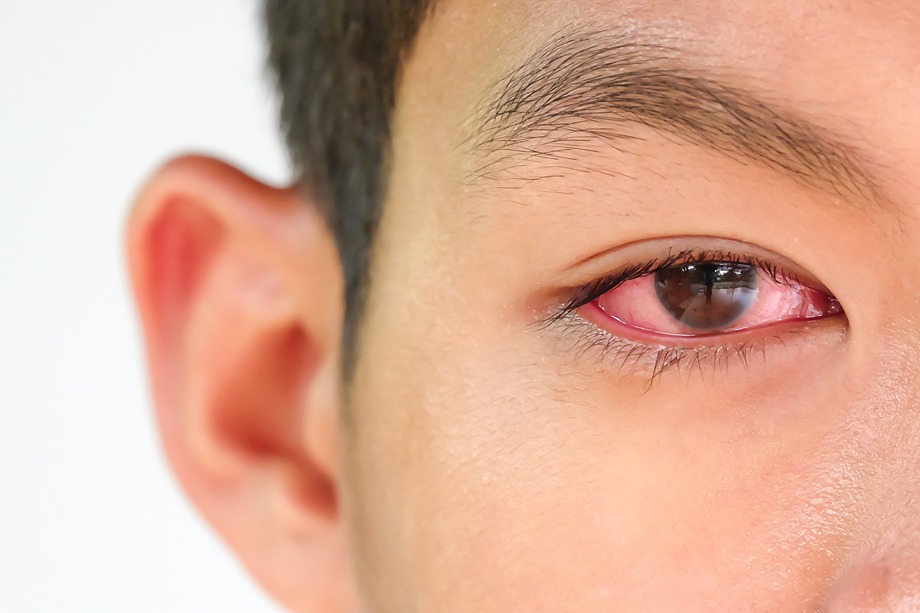 What Causes Bloodshot Eyes Eye Health Central